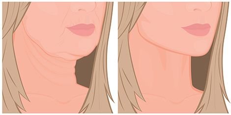 Sagging Jowls Treatment | London Plastic Surgeon